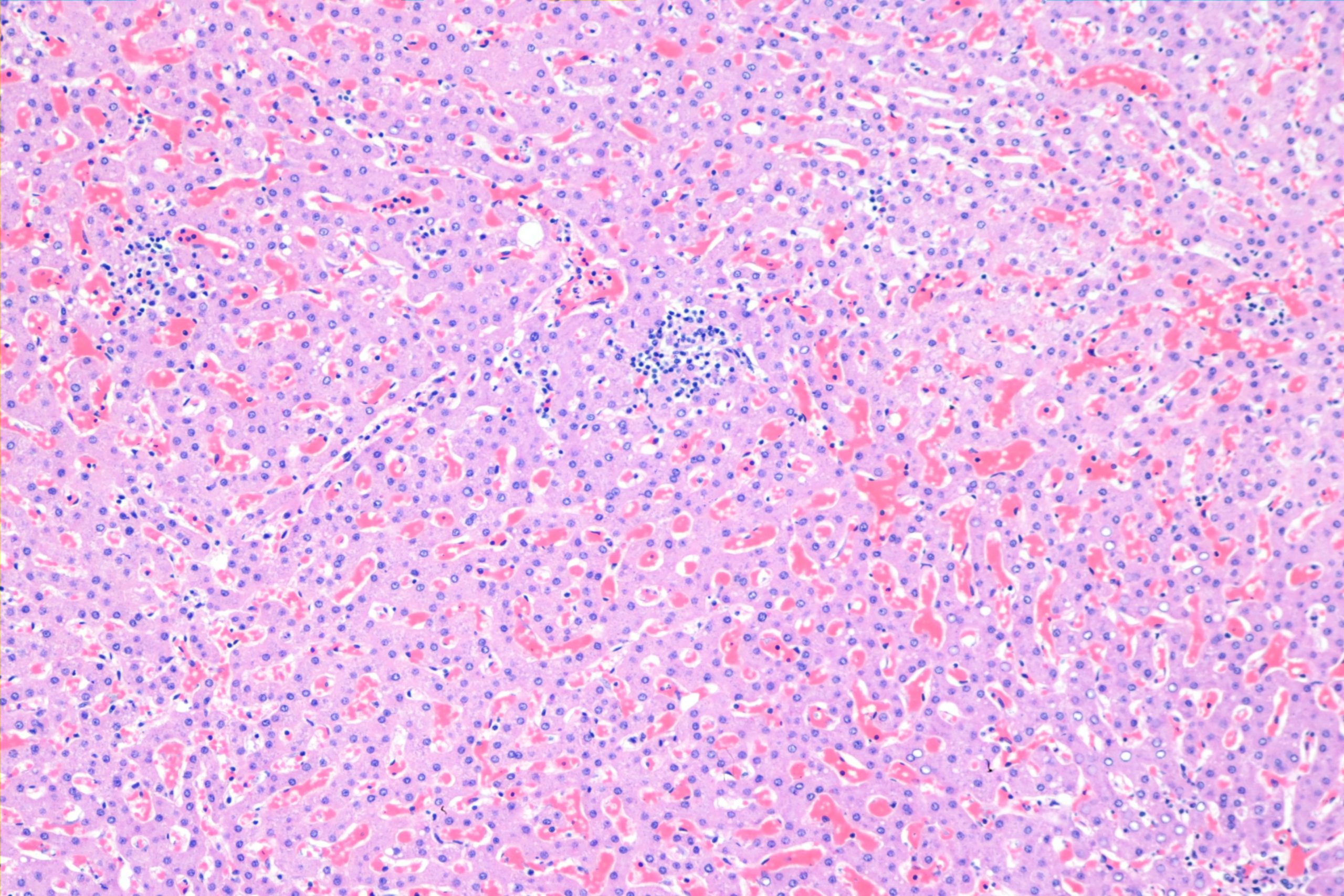Pathology cases — Focal hepatocellular necrosis – Billoblog