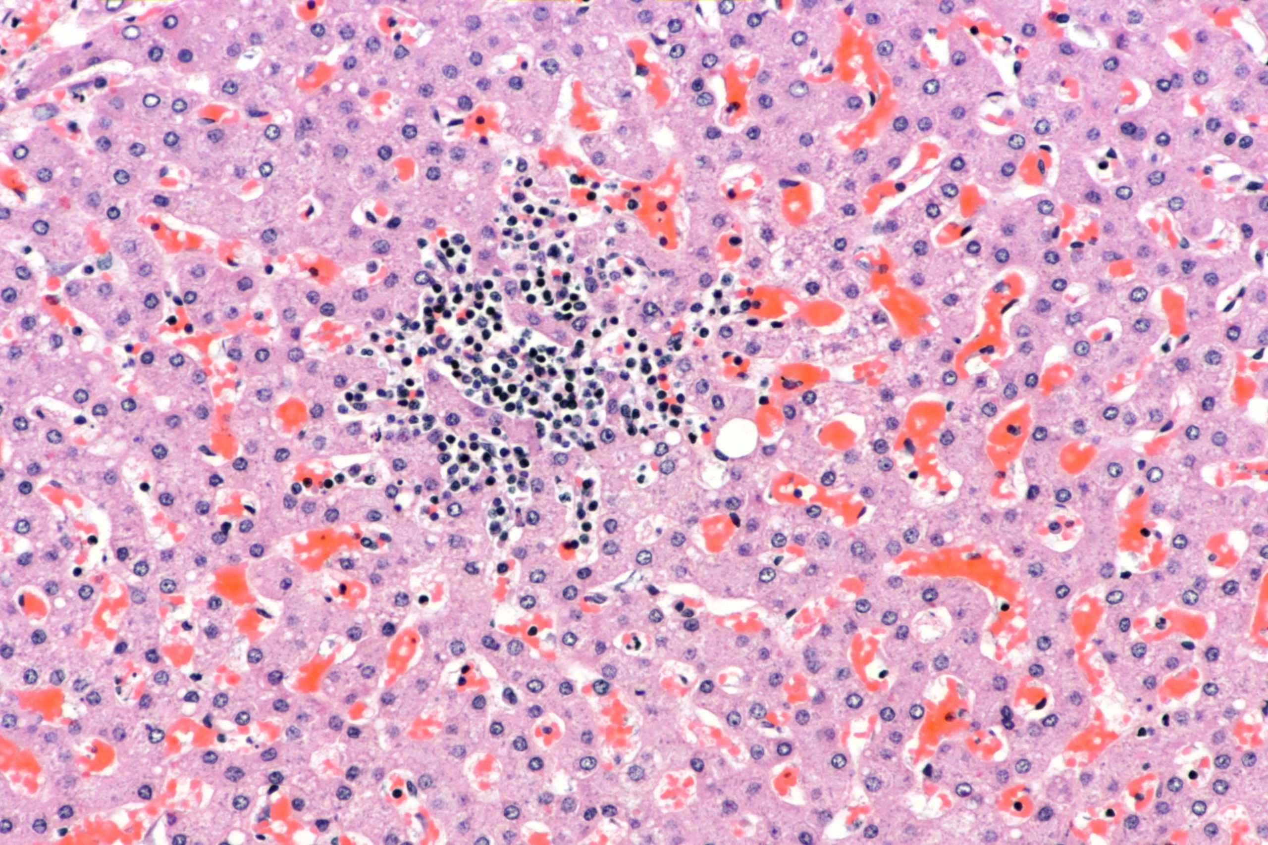 Pathology cases — Focal hepatocellular necrosis – Billoblog