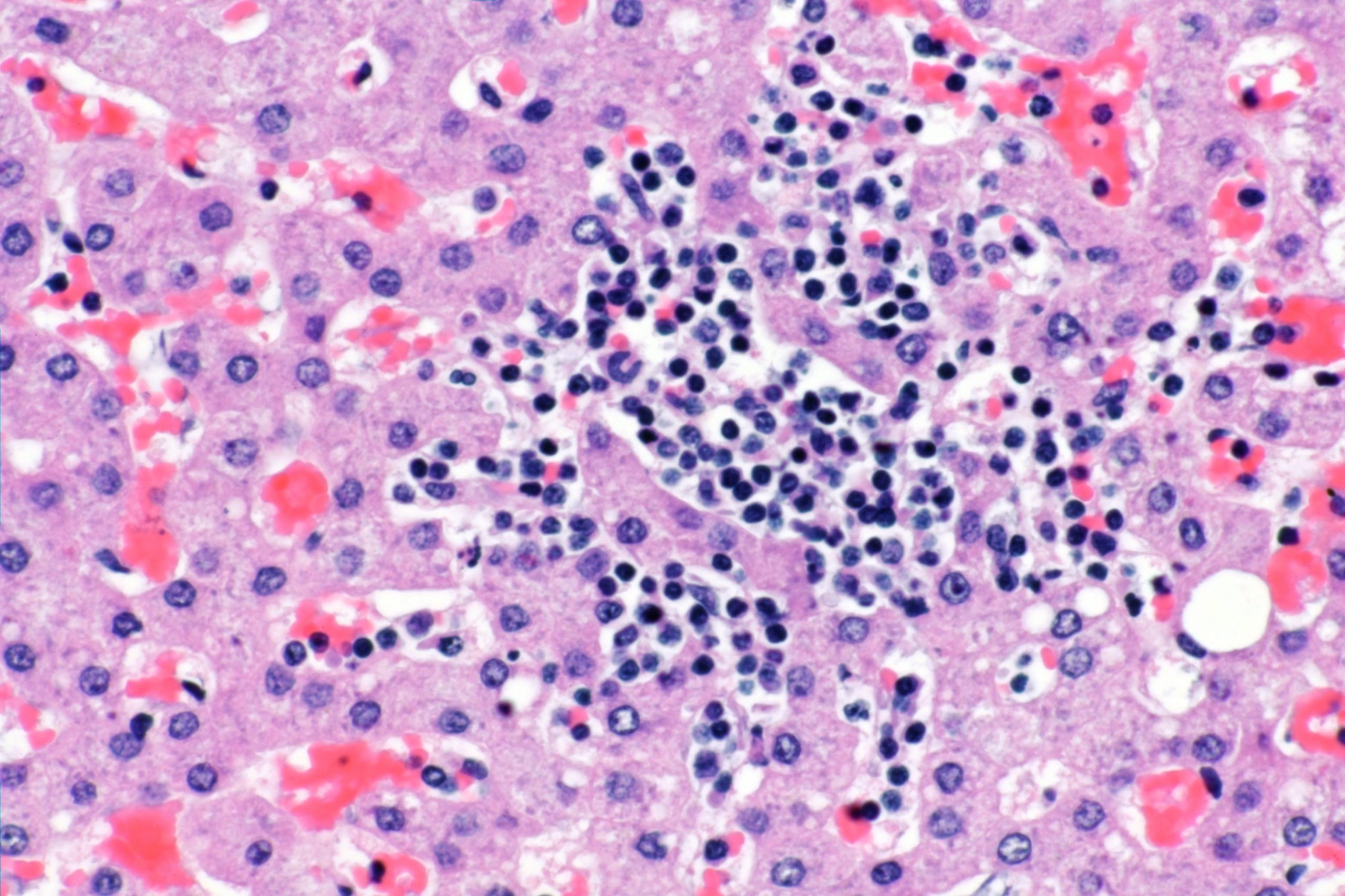 Pathology cases — Focal hepatocellular necrosis – Billoblog