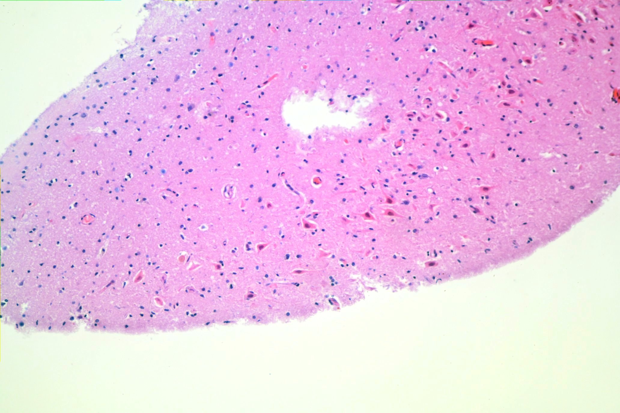 Red neurons in anoxic brain injury – Billoblog