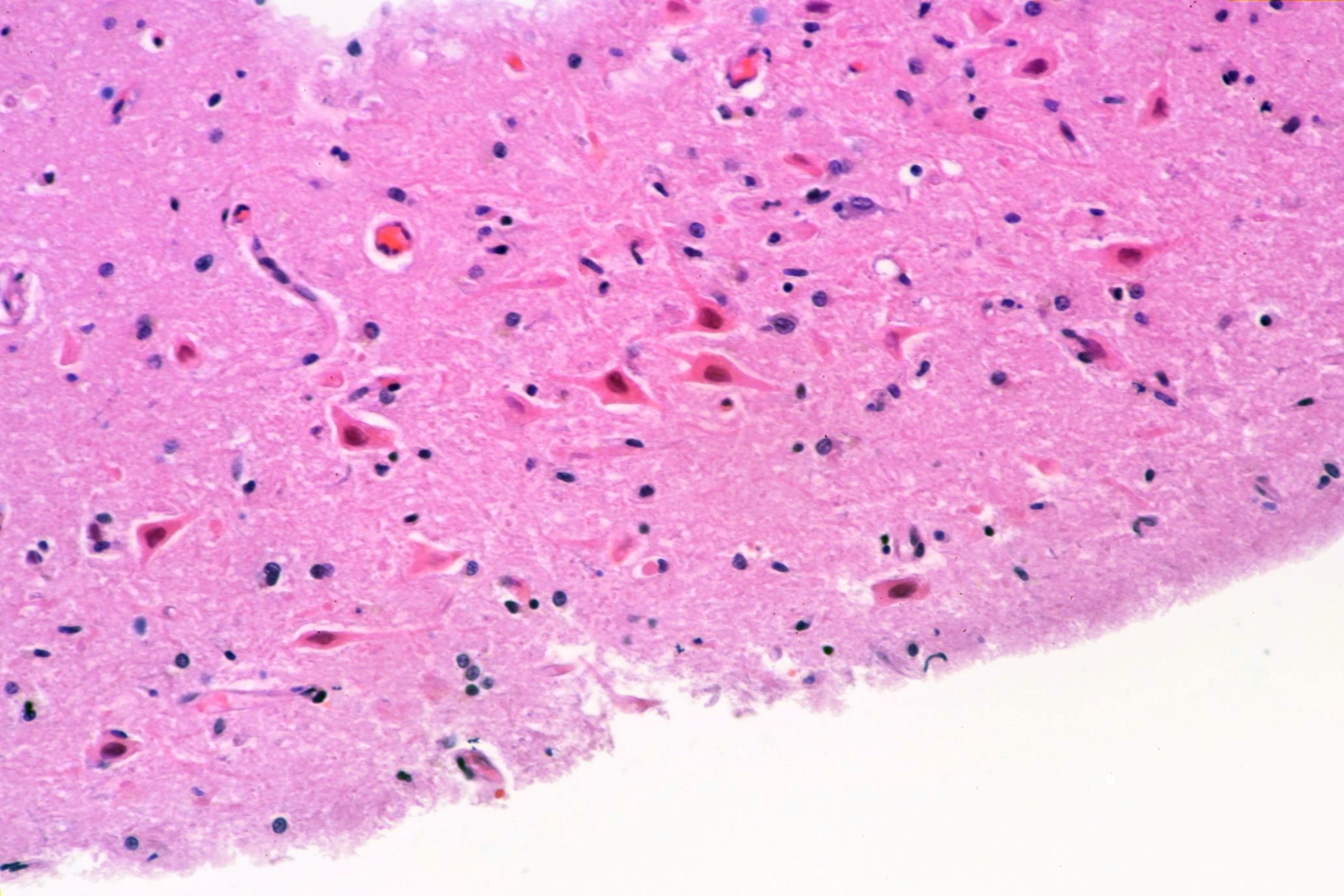 Red neurons in anoxic brain injury – Billoblog