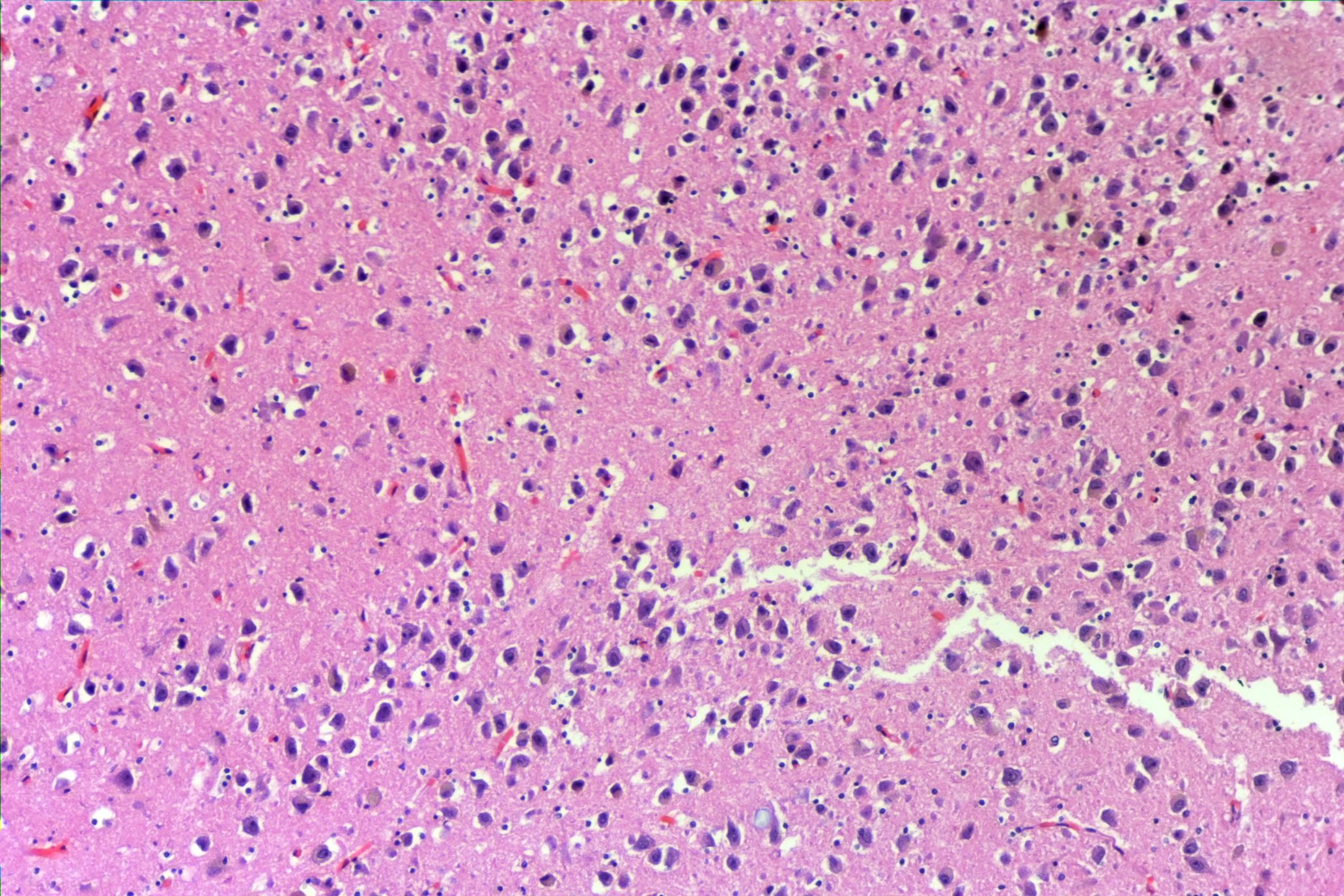 Red neurons in anoxic brain injury – Billoblog