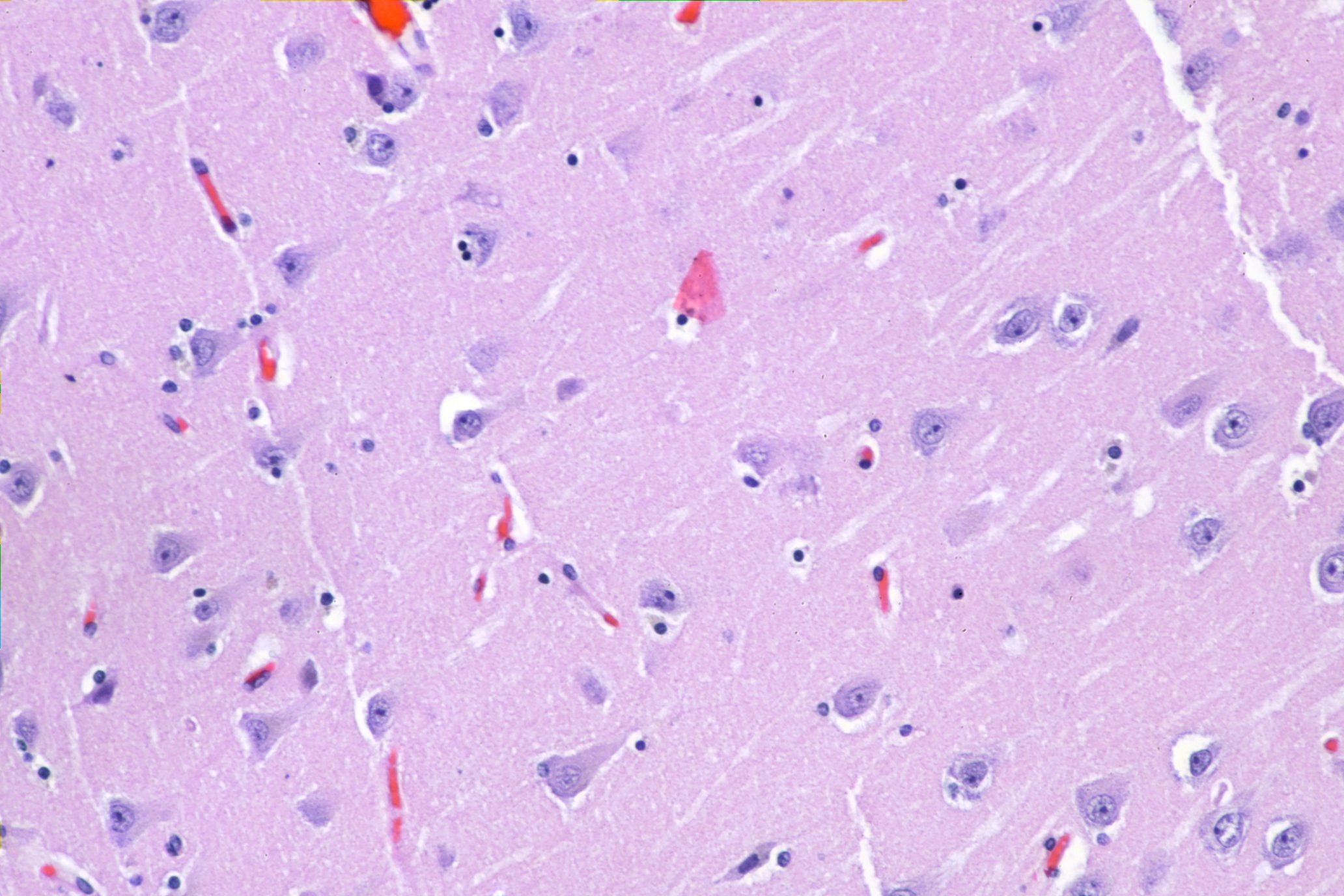 Red neurons in anoxic brain injury – Billoblog