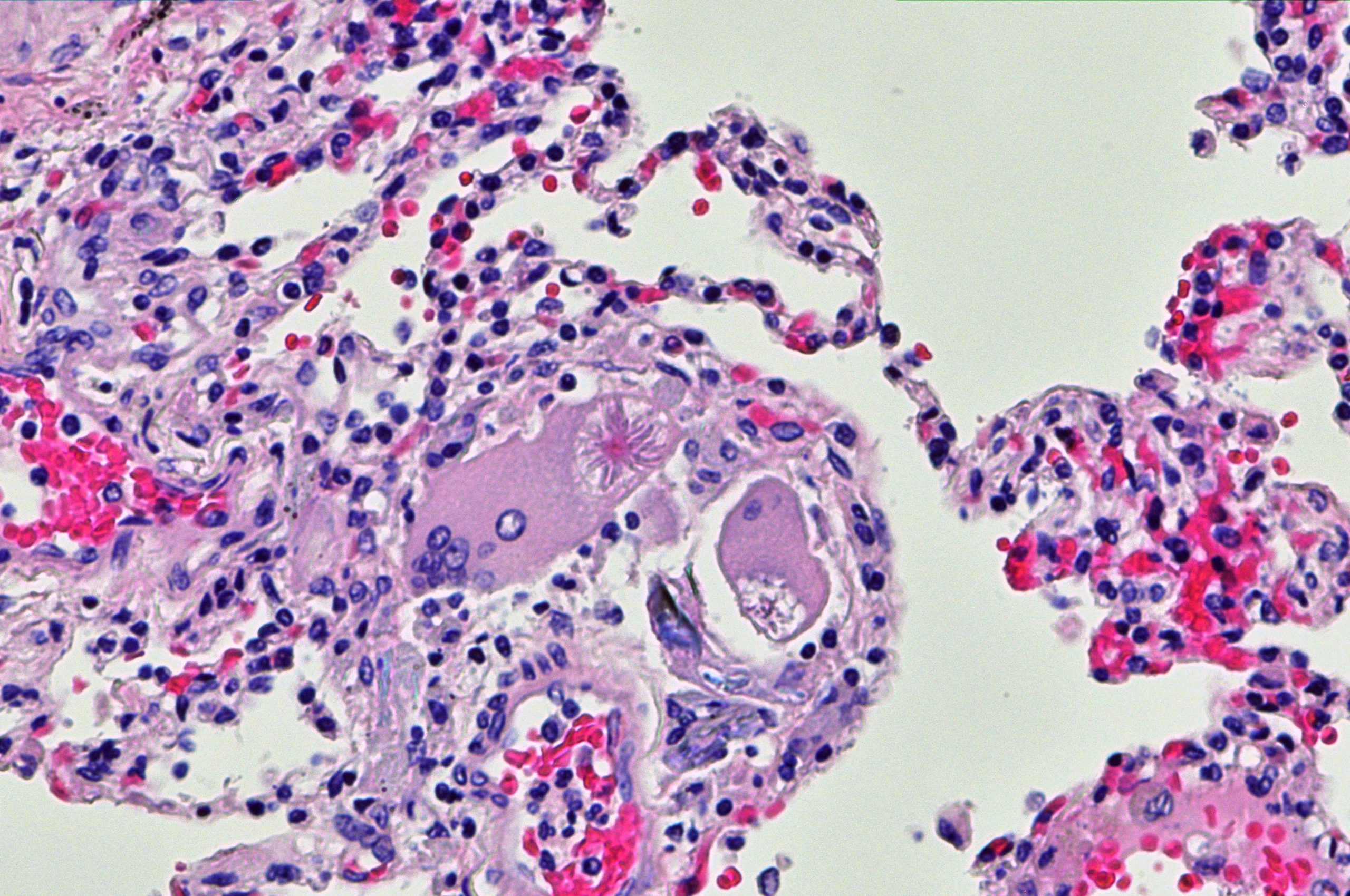 Pathology cases — Asteroid body – Billoblog