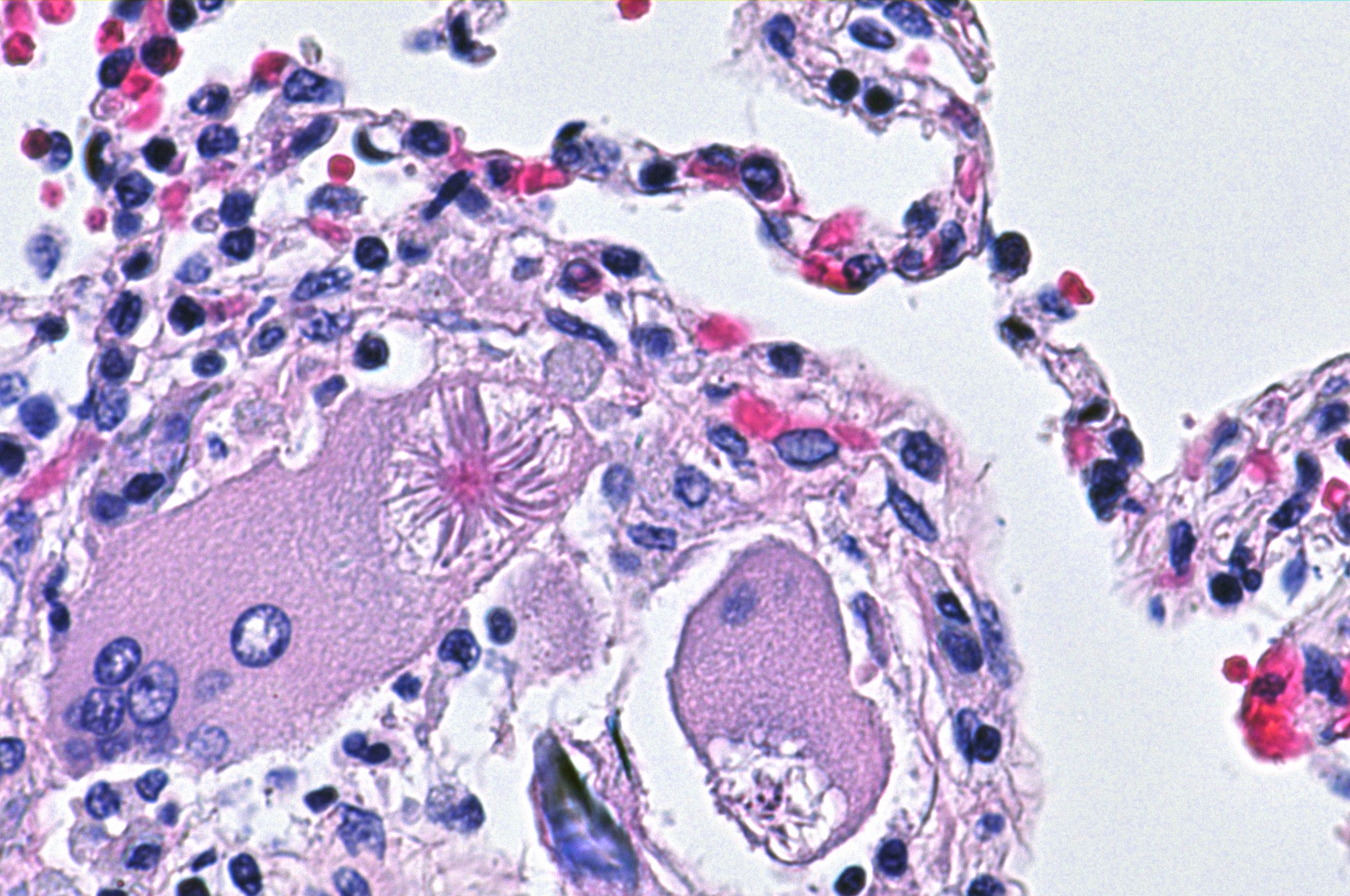 Pathology cases — Asteroid body – Billoblog