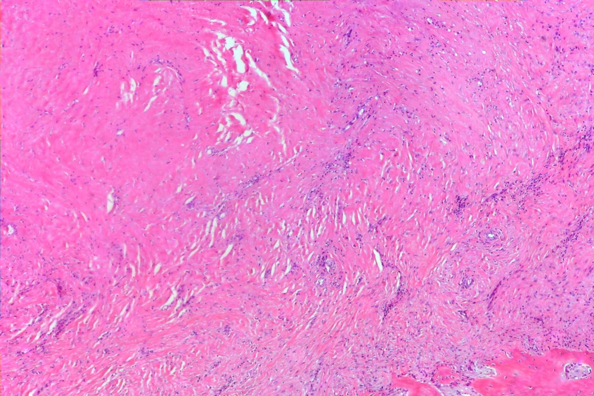 Pathology cases — Inflammatory myofibroblastic tumor of the humerus ...