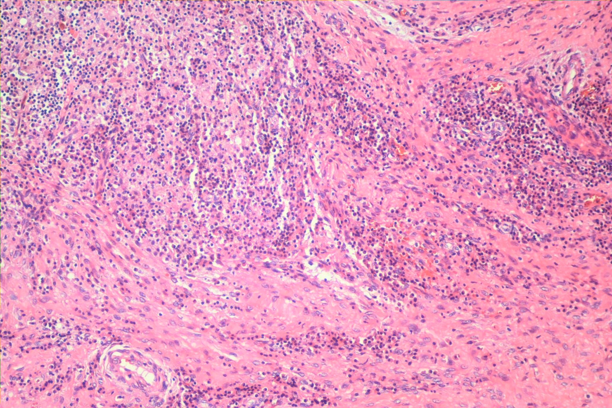Pathology cases — Inflammatory myofibroblastic tumor of the humerus ...