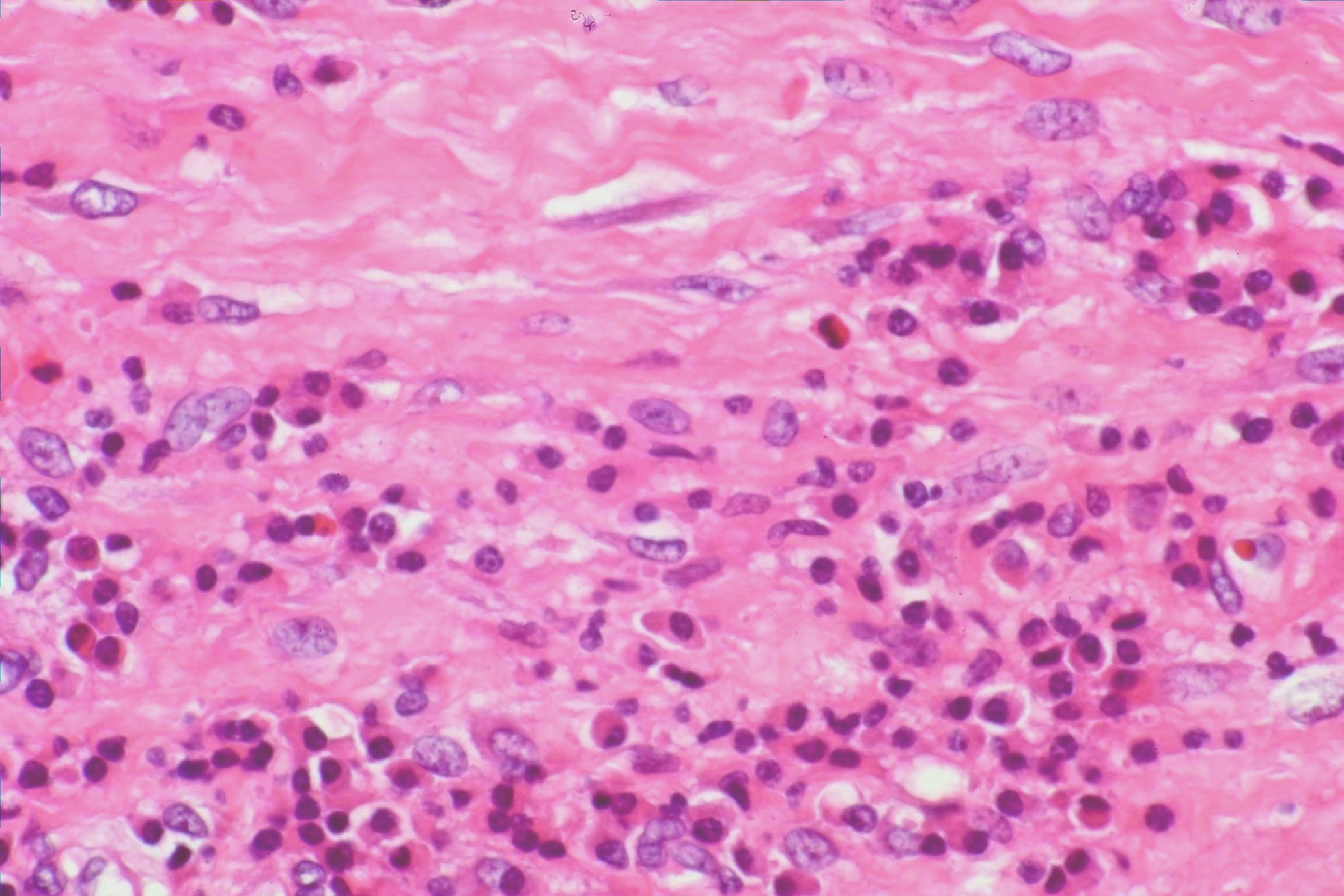 Pathology cases — Inflammatory myofibroblastic tumor of the humerus ...